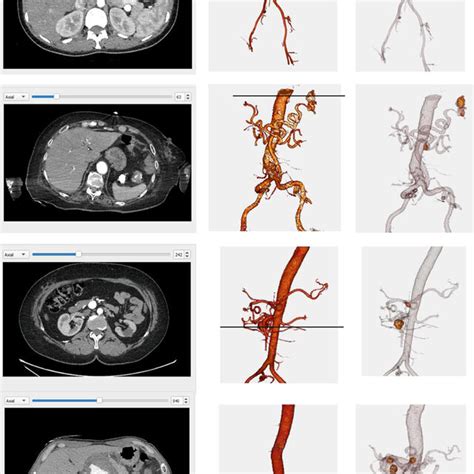 Representative Examples Of Identification Of Visceral Arterial
