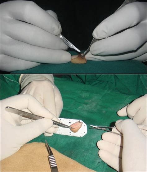 A Positioning The Amputated Part Between Ring Fingers Of Both Hands