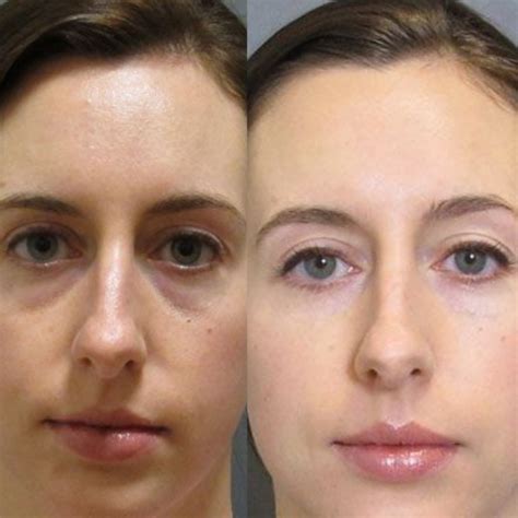 Ultraformer Antes E Depois Preço O Que é Para Que Serve
