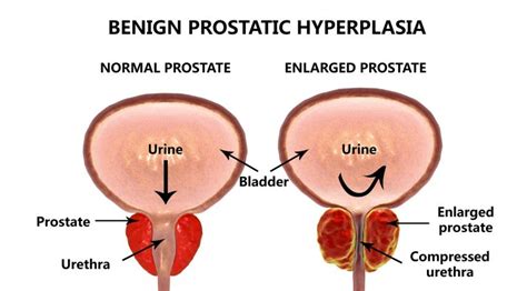Enlarged Prostate Bph Symptoms Diagnosis And Treatment Sydney