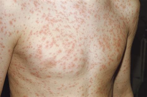 rubella german measles nhs