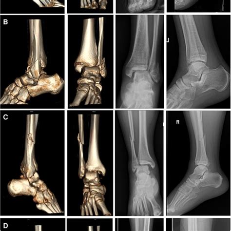 The Ct Reconstructions And Radiographs Of Ankle Fracture Dislocations