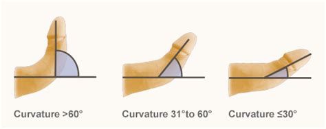 peyronie s disease vs normal curvature — fairbanks urology