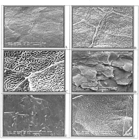 Figure 1 From Sem Analysis Of Oral Lichen Planus Before And After