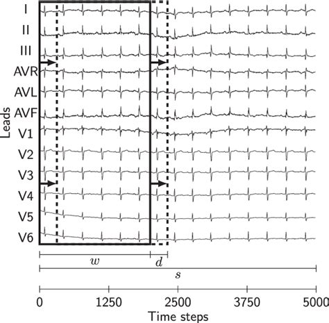 Figure 1 From Detecting Myocardial Scar Using Electrocardiogram Data