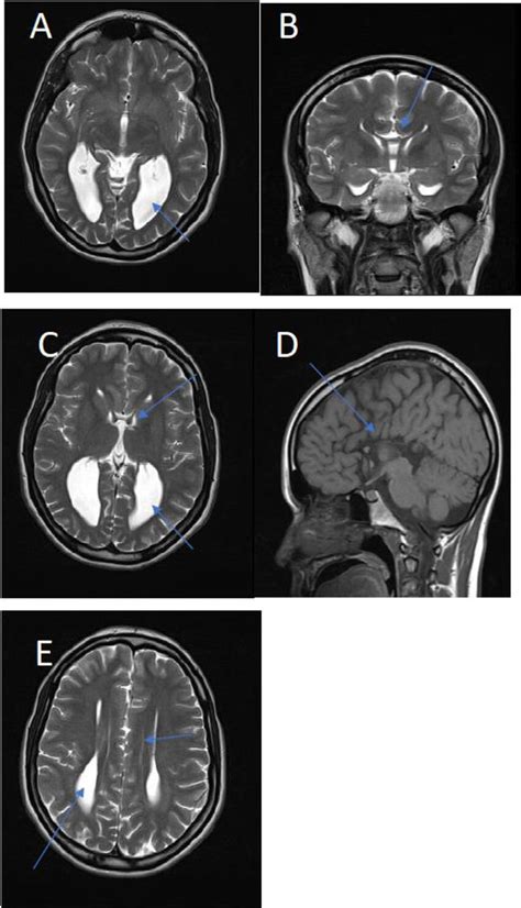 A Axial T2 Brain Mri Sequence With Dilatation Of The Occipital Horns