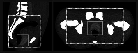 Dose Reduction And Low Contrast Detectability Using Iterative Cbct