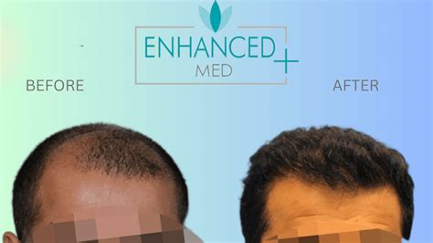 Best Dhr Hair Transplant Clinic In Delhi India Enhanced Med Clinics