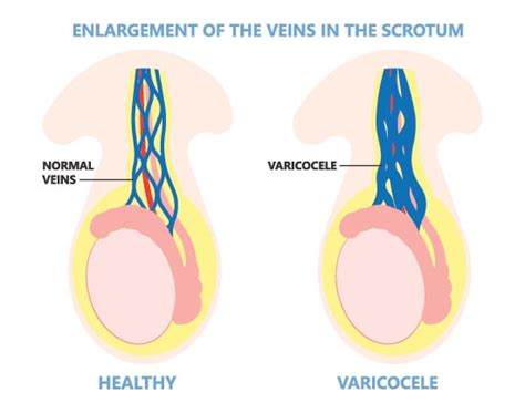 Varicocele Repair Los Angeles San Francisco Varicocelectomy