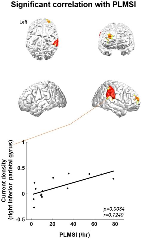Correlation Between Plmsi And Cortical Activity At The Right Inferior