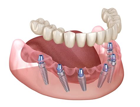 The Complete Guide To Full Mouth Dental Implants Everything You Need