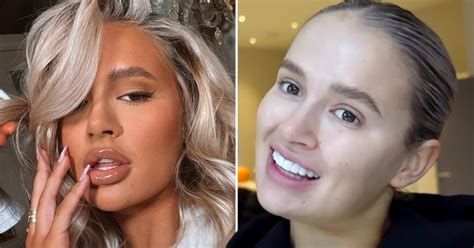 Molly Mae Hagues Lips Have ‘stretched After Having Fillers Dissolved