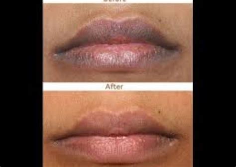 get dark line around my lips