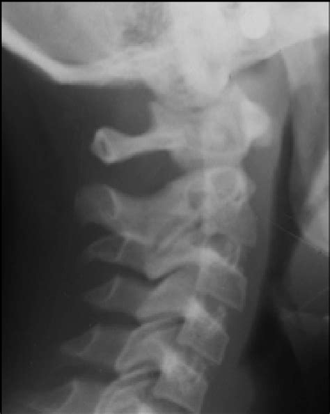 Figure 1 From Cervical Vertebrae Maturation Method Morphologic Criteria