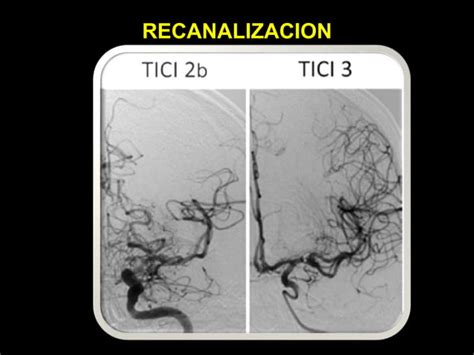 Manejo Del Ictus Isquémico Agudo Terapia Endovascular