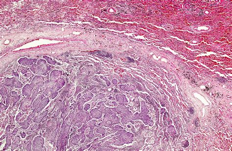 Squamous Cell Carcinoma Of The Lung Light Micrograph Stock Image