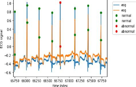 Figure 1 From Classification Of Arrhythmia In Time Series Ecg Signals