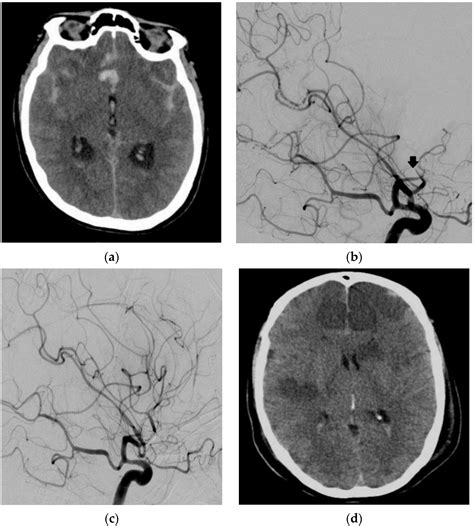 Jcm Free Full Text Vasospasm Related Death After Aneurysmal