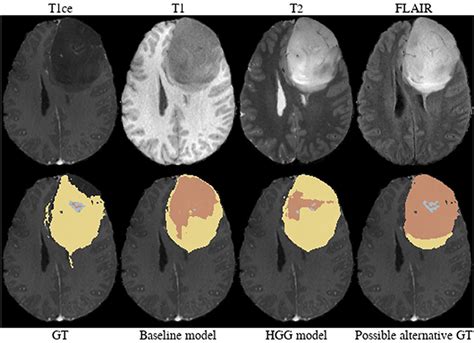 Frontiers Divide And Conquer Stratifying Training Data By Tumor