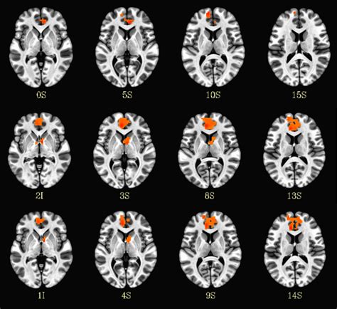 Functional Activation To Monetary Reward Outcome Gain Condition
