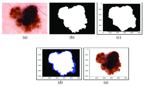 Segmentation Of The Dermoscopic Image By The Proposed Method A