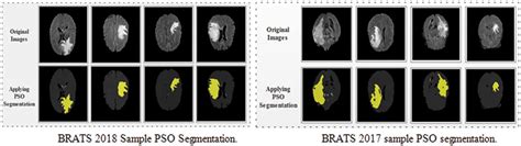 Brain Tumor Detection And Classification Using Pso And Convolutional