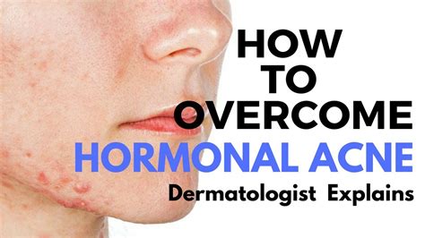 Skin Care Tips Treating Hormonal Acne Youtube