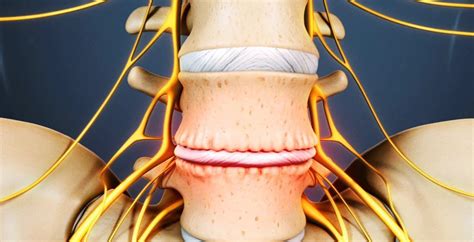 La Radiculopatía Lumbar Causante De La Ciática Doctor Carlos Ochoa