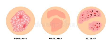Psoriasis Stock Illustrations 5 320 Psoriasis Stock Illustrations
