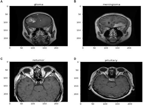 Frontiers Enhancing Brain Tumor Classification In Mri Scans With A