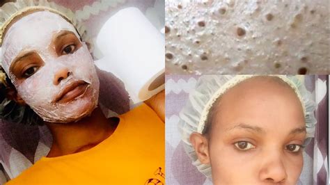 Easy Diy Egg Facial Mask Acne And Blackheads Removal Youtube