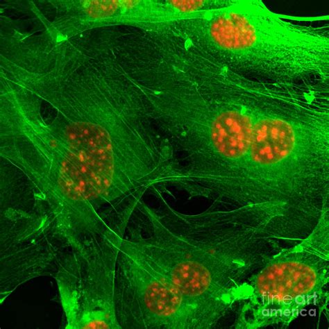 Emerging Cells Breast Cancer Fm Photograph By Science Source Fine