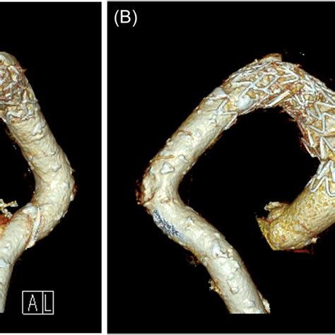 Preoperative Three‐dimensional Reconstruction Obtained From Computed