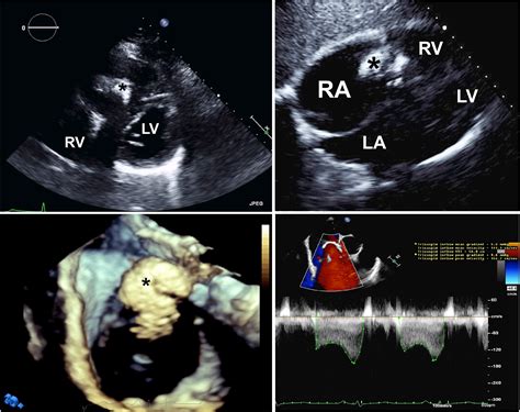 Multimodal Imaging Of Isolated Tricuspid Valve Calcification Causing