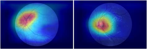 Frontiers Multi Label Classification Of Retinal Disease Via A Novel