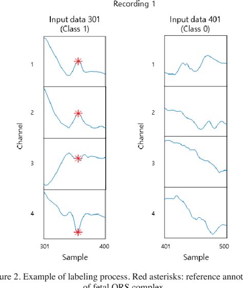 Fetal Qrs Detection Based On Convolutional Neural Networks In
