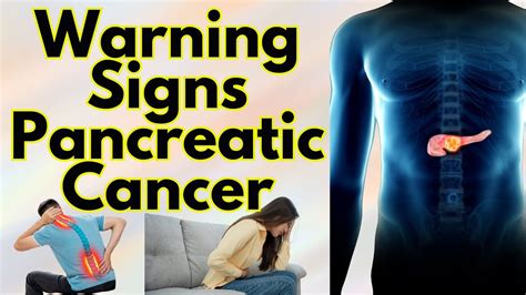 10 Shocking Warning Signs Of Pancreatic Cancer You Cant Ignore Youtube