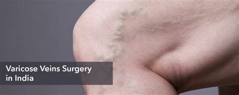 Varicose Veins Surgery Cost In India Varicose Veins Treatment India