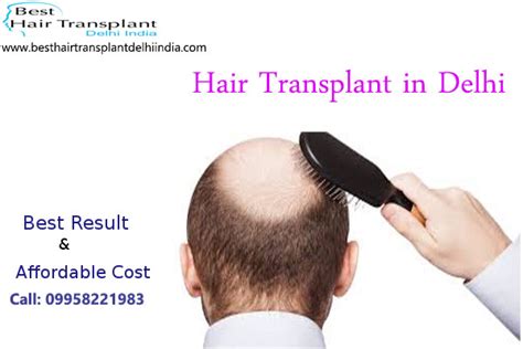 Hair Loss Treatments For Retaining Hairs And Transplant To Regain Them