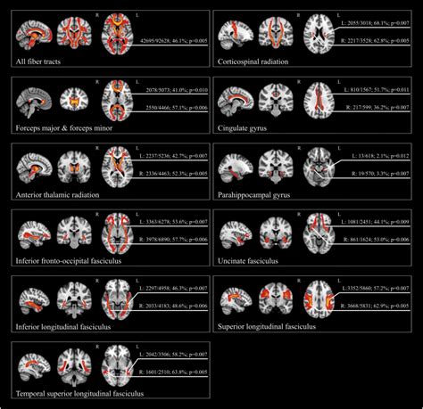 Widespread White Matter Connectivity Abnormalities In Narcolepsy Type 1