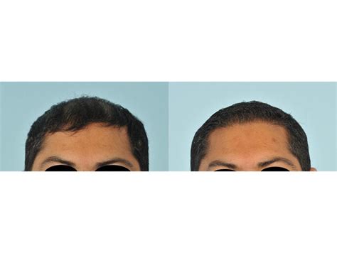 Before And After Jesse E Smith Md Facs Ft Worth Colleyville Facial