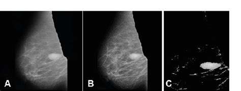 Figure 4 From A Model For Mammogram Image Segmentation Based On Hybrid