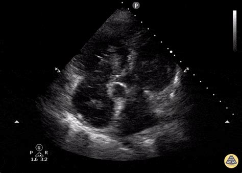 Pulmonary Embolism Archives Ucsd Ultrasound