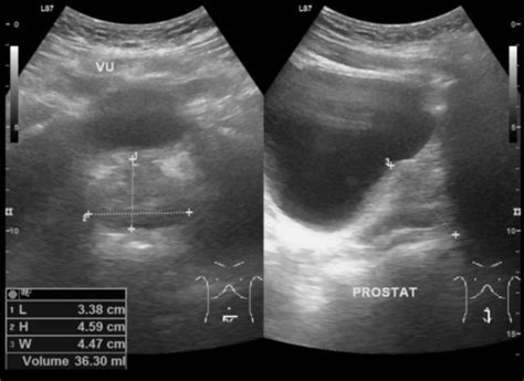 Prostate Volume Calculation With Transabdominal Ultrasonography On