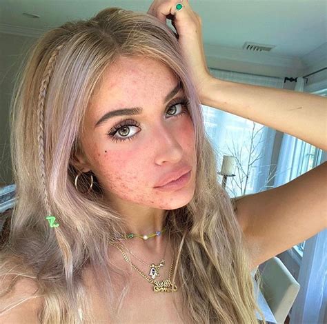 Makes You Beautiful Beautiful People Acne Photos Girl With Acne