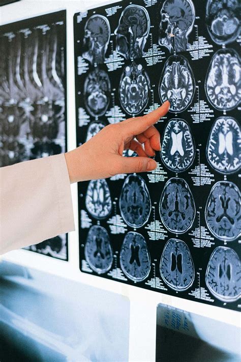 Cómo Identificar Un Derrame Cerebral