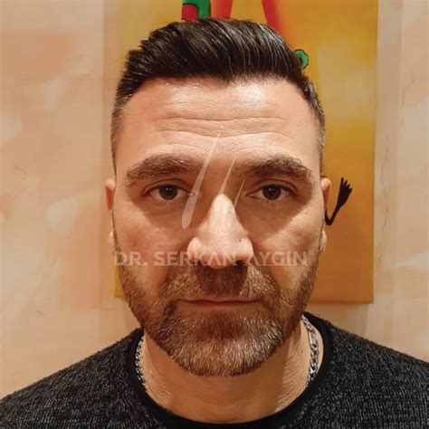 Haartransplantation Türkei Vorher Nachher Ergebnisse Dr Serkan Aygin
