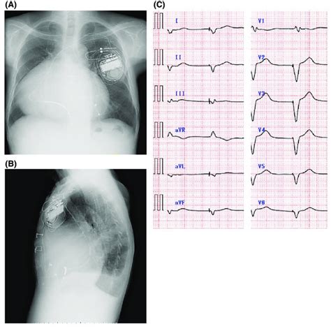 Posteroanterior A And Lateral B Views Of Chest Radiograph And