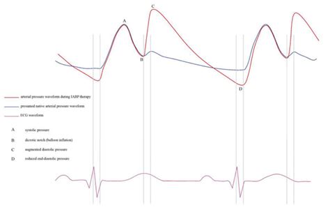 Intra Aortic Balloon Pump Counterpulsation Wfsa Resources