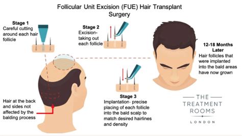 A Guide To Hair Transplants And Donor Area Recovery